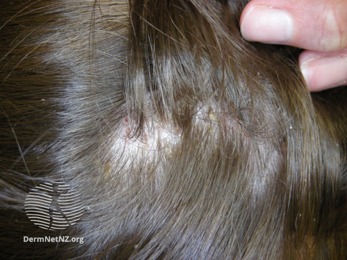 A Child with an Itchy Scalp