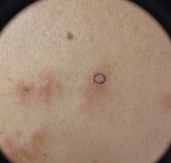 A Man with a Rash on His Back