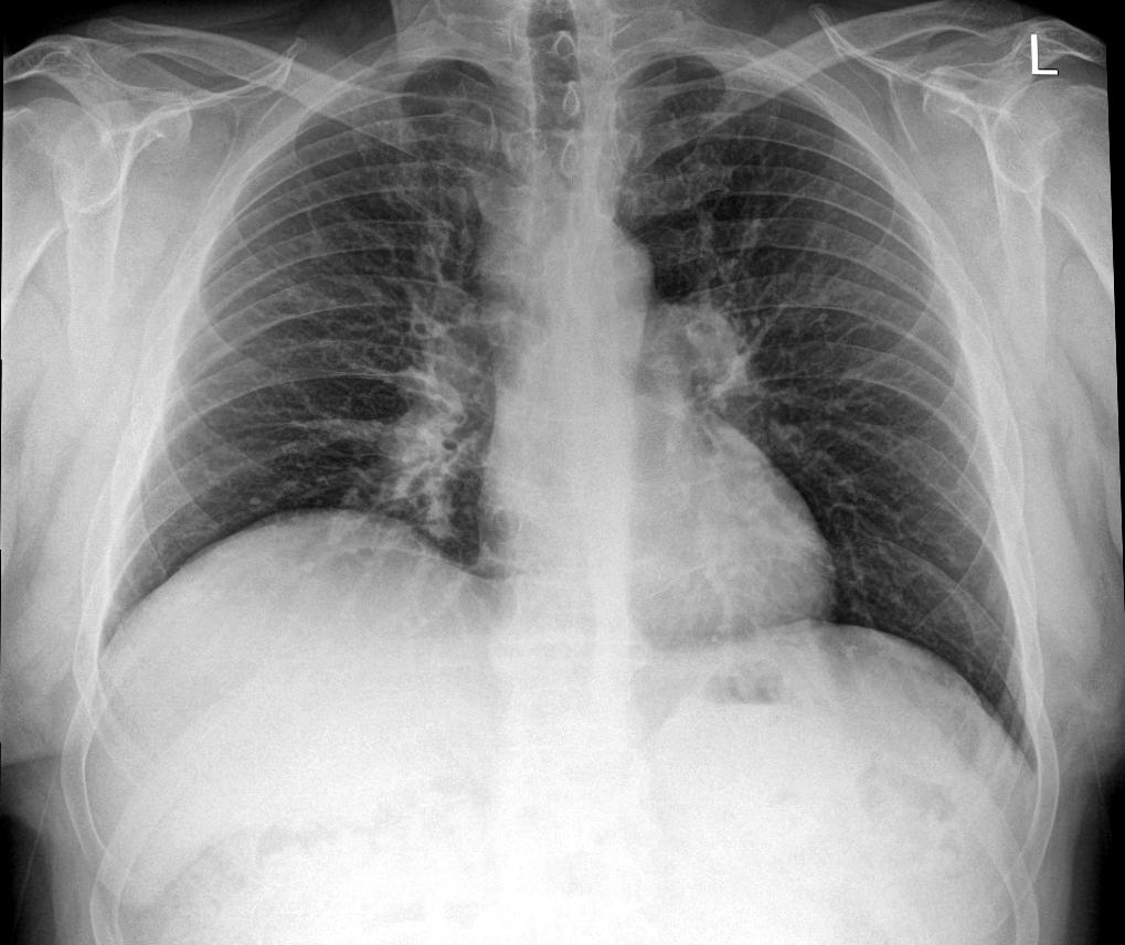 A Mysterious Rash in a Patient with Interstitial Lung Disease