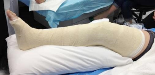 Acute Compartment Syndrome