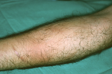 Acute Compartment Syndrome