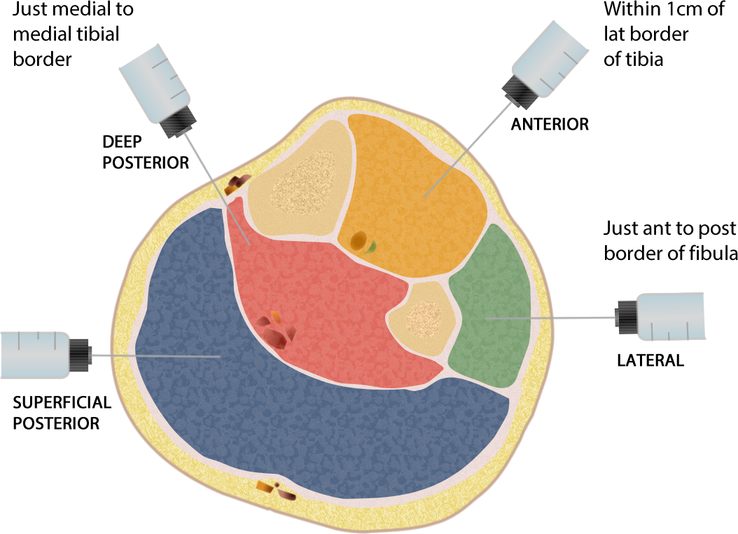 Acute Compartment Syndrome