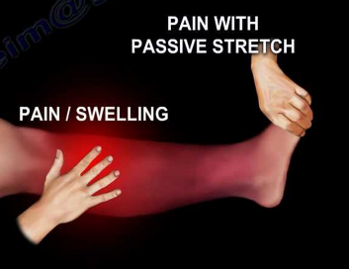 Acute Compartment Syndrome