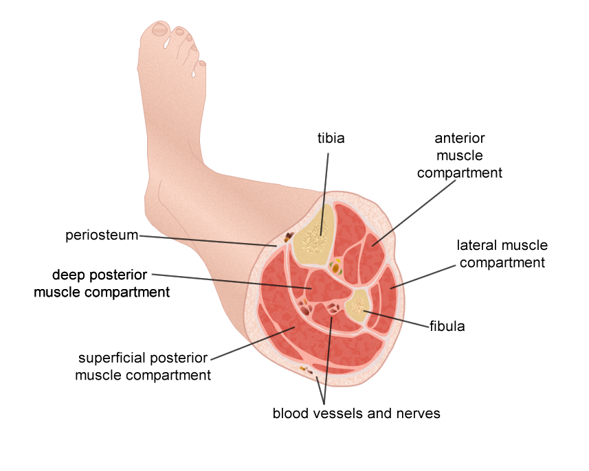 Acute Compartment Syndrome