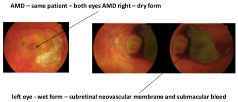 Age-Related Macular Degeneration