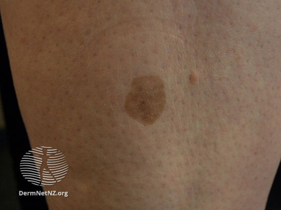 Benign Skin Lesions