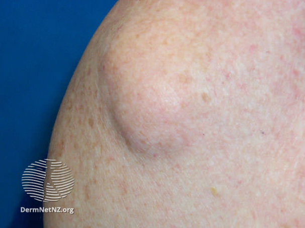 Benign Skin Lesions