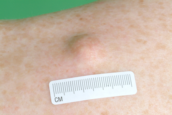 Benign Skin Lesions