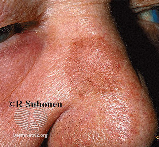 Benign Skin Lesions