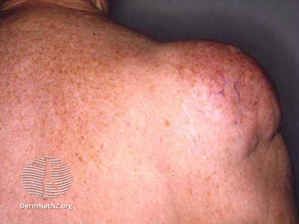 Benign Skin Lesions