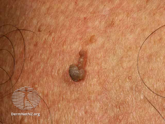 Benign Skin Lesions