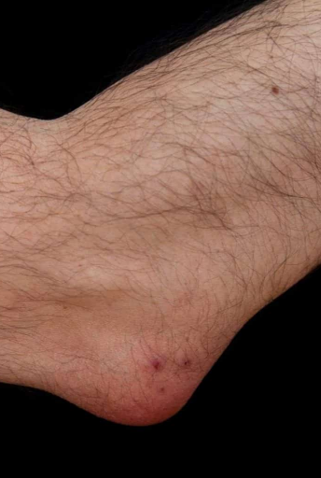 Bursitis and Septic Arthritis