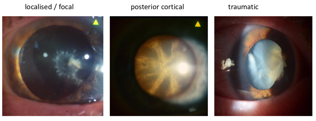 Cataract