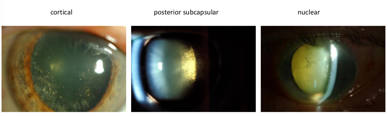 Cataract