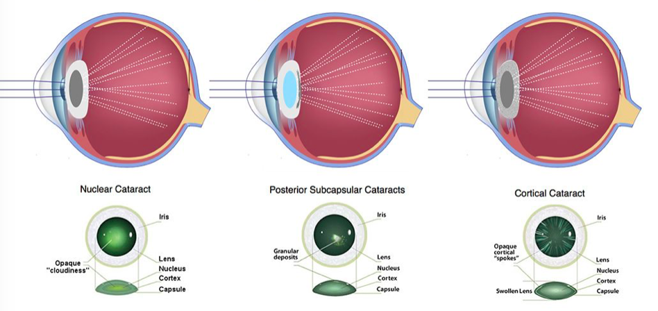 Cataract