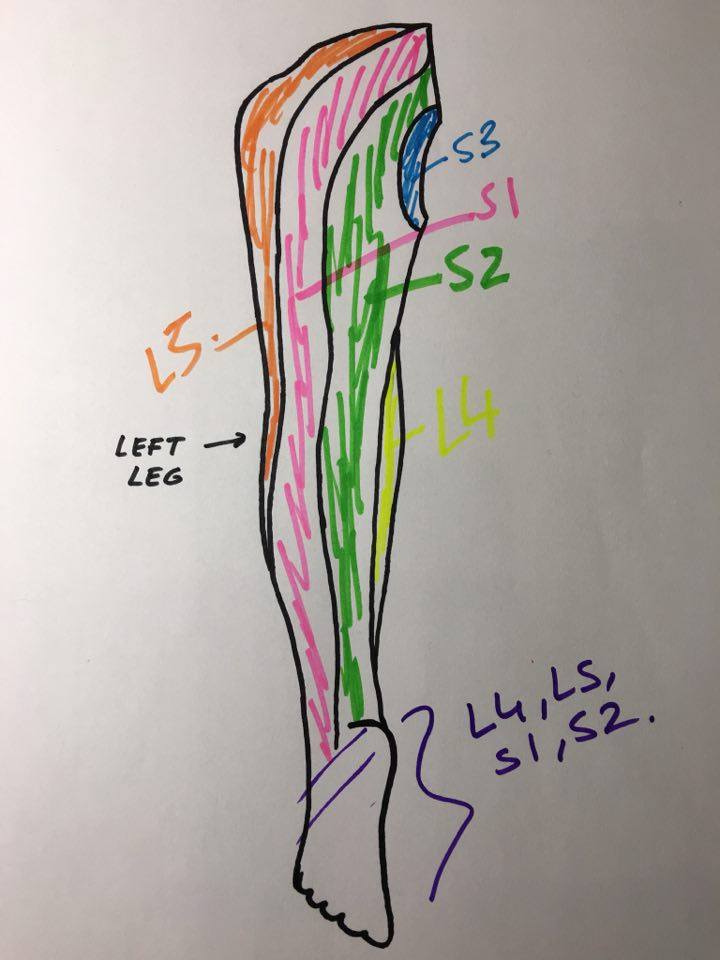 Cauda Equina Syndrome and the Lower Spinal Cord