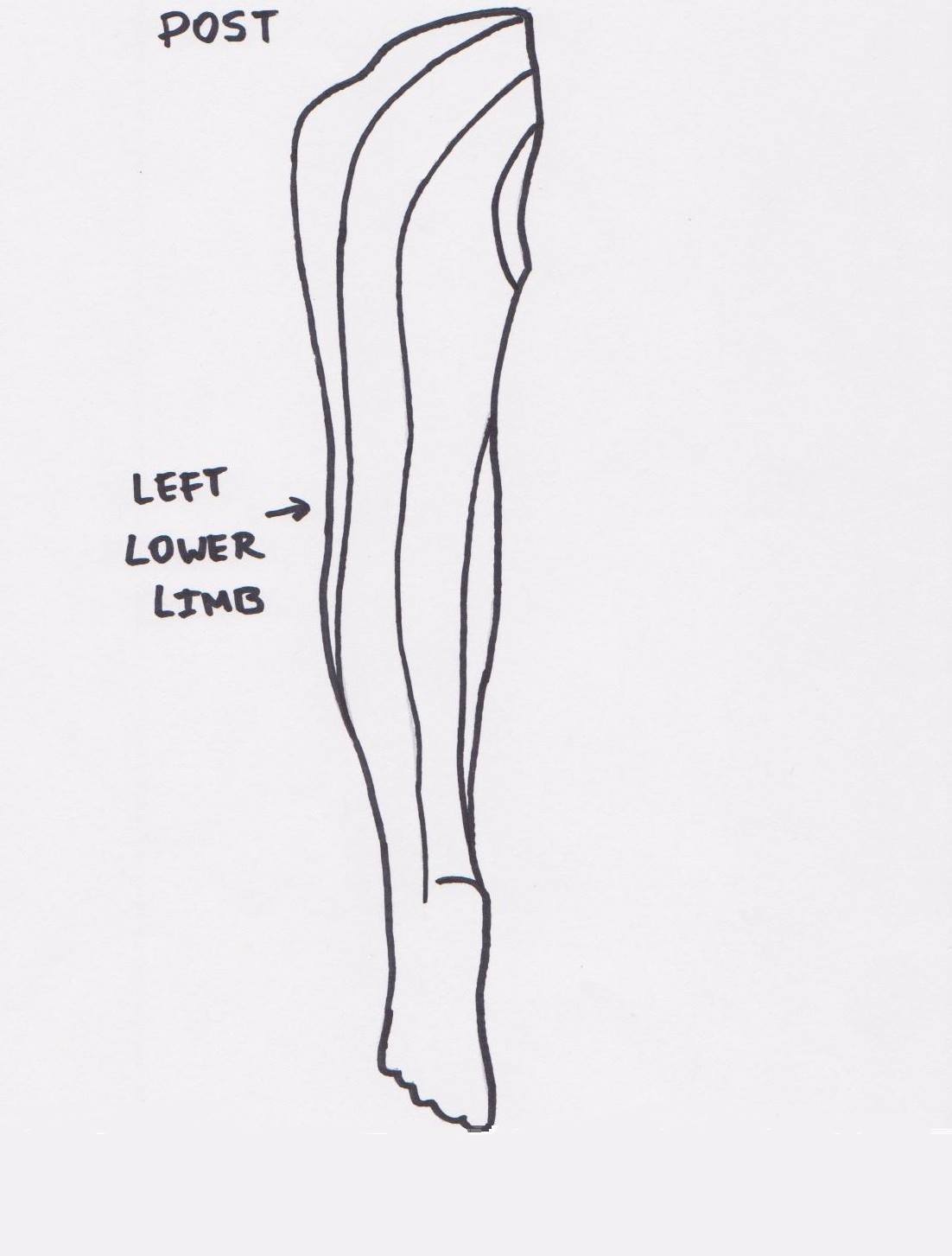 Cauda Equina Syndrome and the Lower Spinal Cord