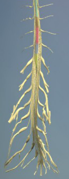 Cauda Equina Syndrome and the Lower Spinal Cord