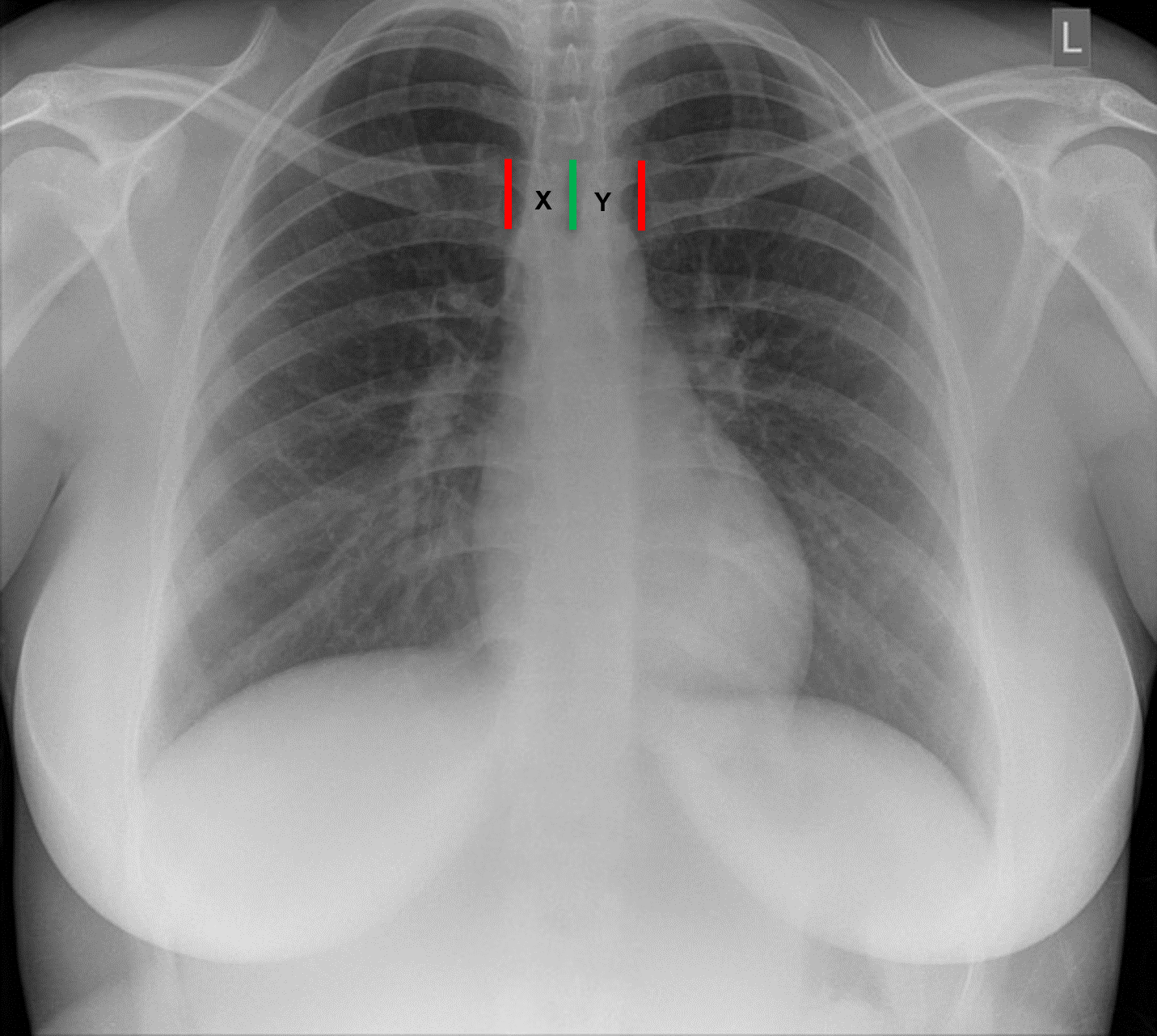 Chest X-ray Interpretation