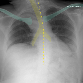 Chest X-ray Interpretation