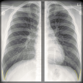 Chest X-ray Interpretation