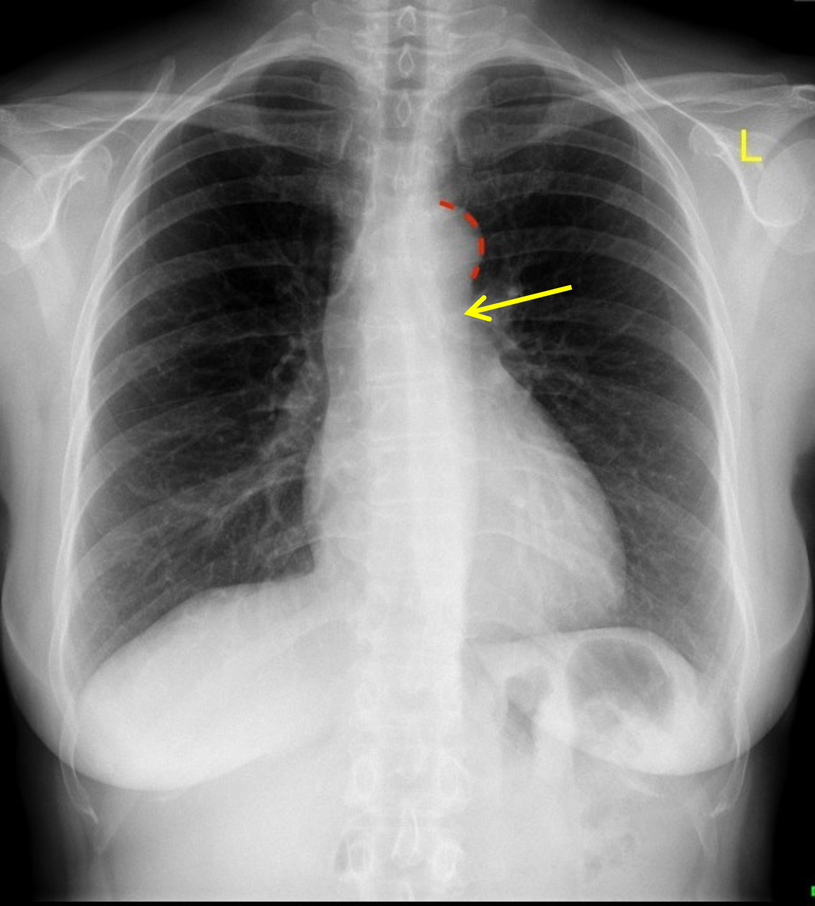 Chest X-ray Interpretation