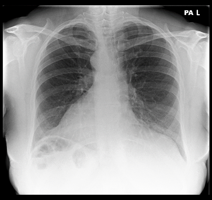 Chest X-ray ward round