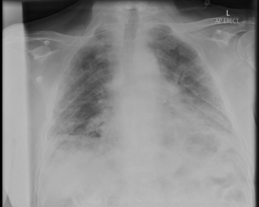 Chest X-ray ward round