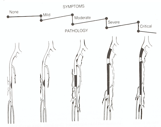 Chronic Limb Ischaemia