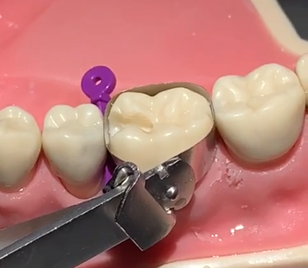 Mod Amalgam Restoration