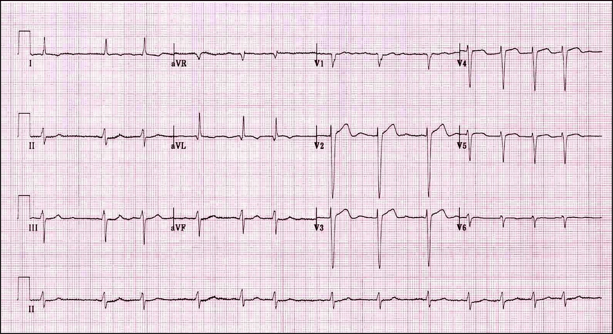 Ventricular Fibrillation Vs Ventricular Tachycardia Ecg