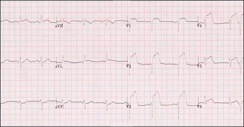 ECG Interpretation
