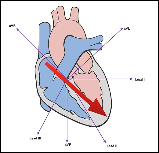 ECG Interpretation