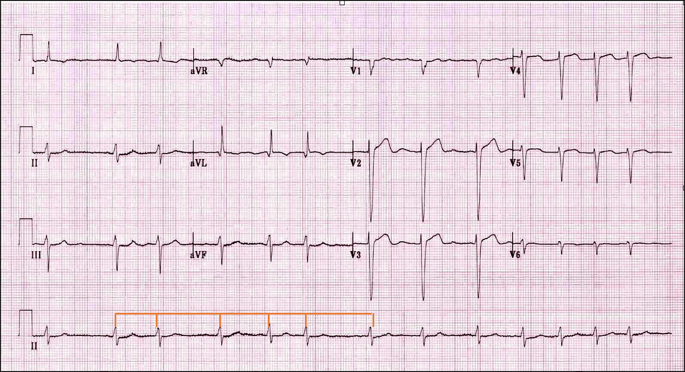 ECG Interpretation