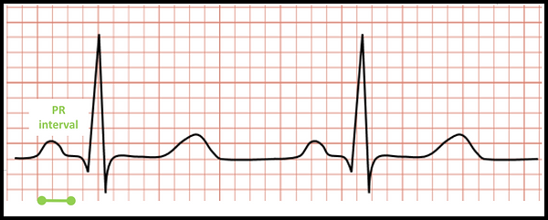 ECG Interpretation