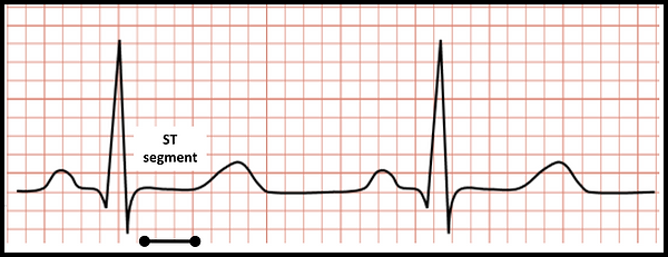 ECG Interpretation