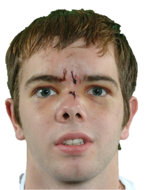 Identifying the Fractured Mandible