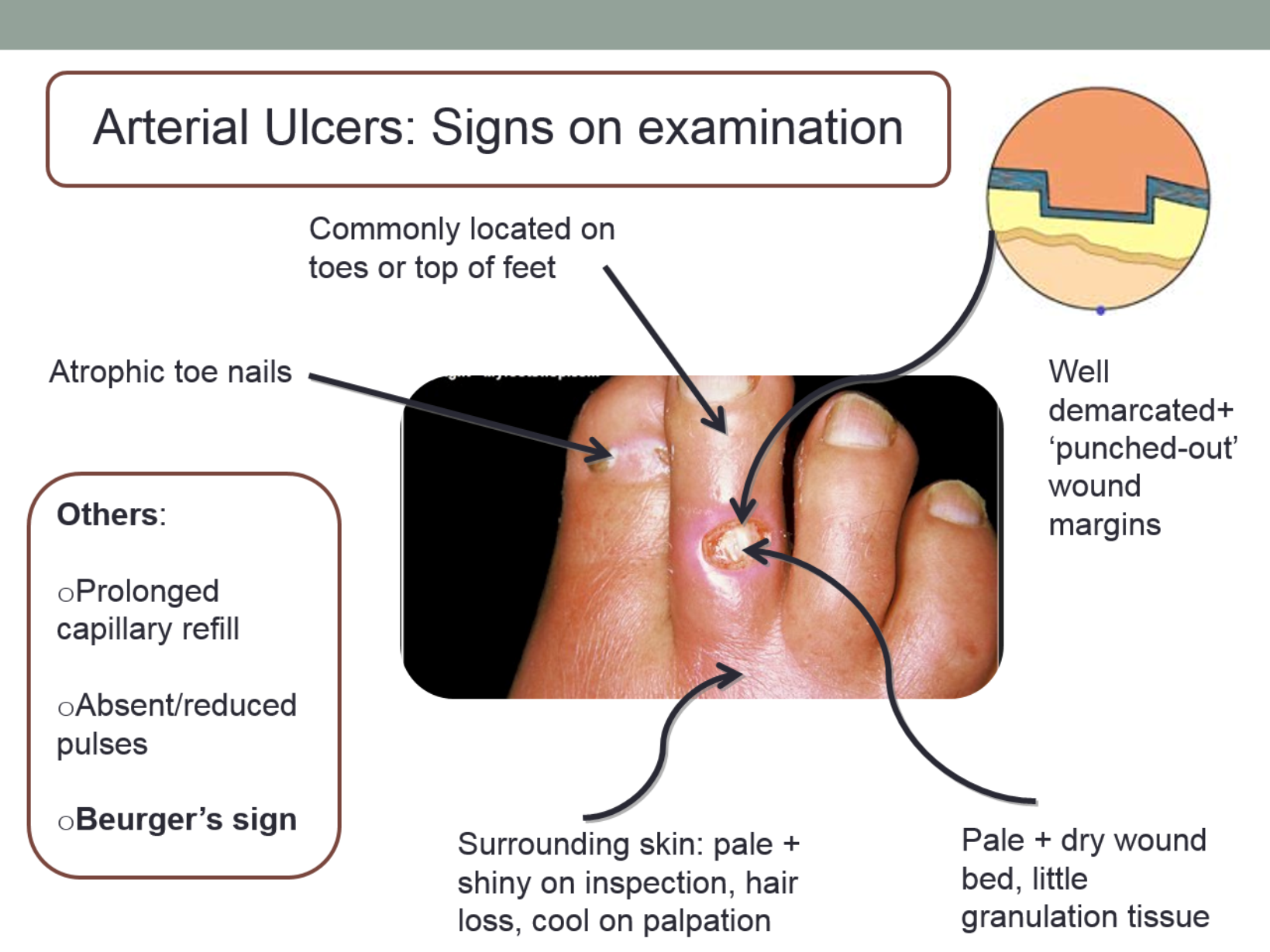 Leg Ulcers and Pressure Sores 3