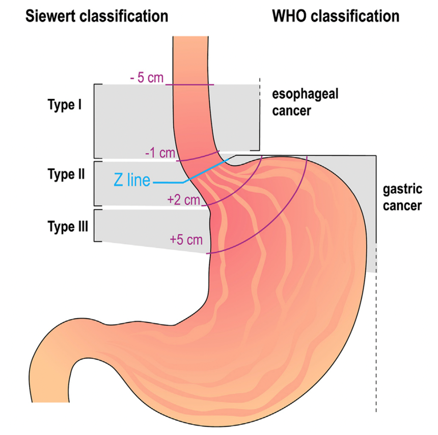 Oesophageal Cancer