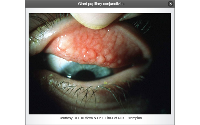 Allergic Conjunctivitis Cobblestone