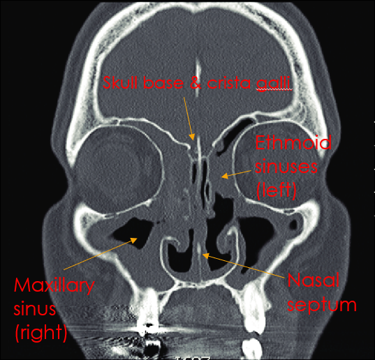 Ct Sinuses Anatomy Anatomy Drawing Diagram Normal Frontal Recess