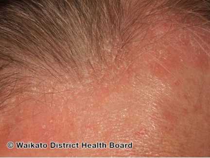Skin Conditions Commonly Presenting to GP