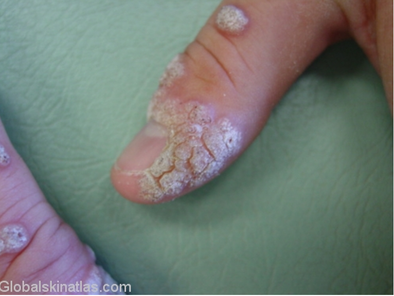 Skin Infections and Infestations