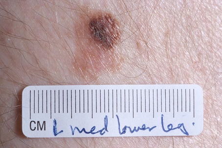 Skin Lesions Encyclopaedia