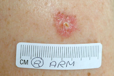 Skin Lesions Encyclopaedia