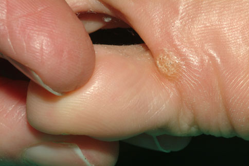 Skin Lesions Encyclopaedia