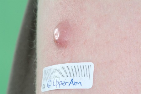 Skin Lesions Encyclopaedia