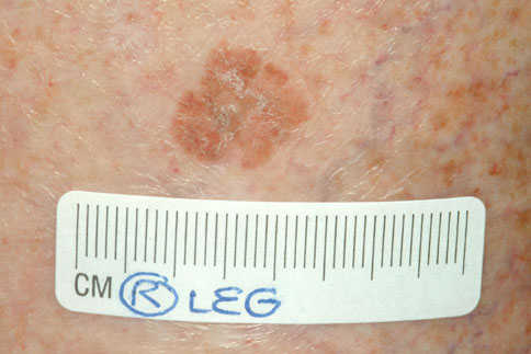 Skin Lesions Encyclopaedia