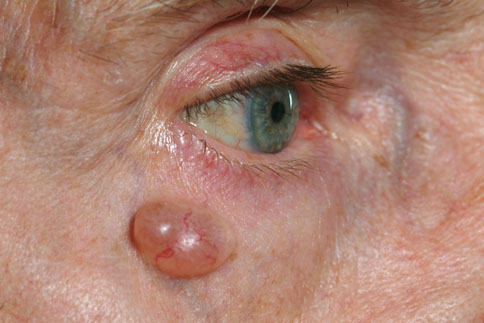 Skin Lesions Encyclopaedia