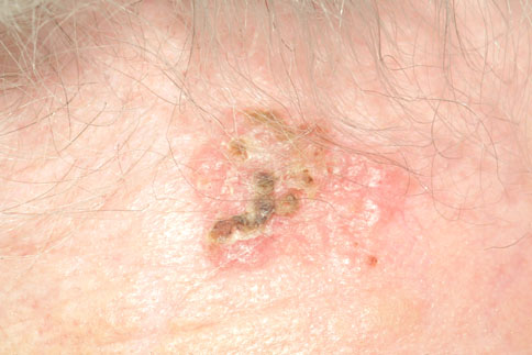 Skin Lesions Encyclopaedia